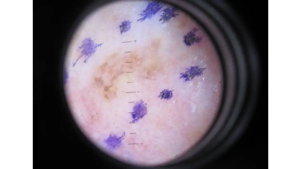 Life After Melanoma: What Most Survivors Miss in 2026