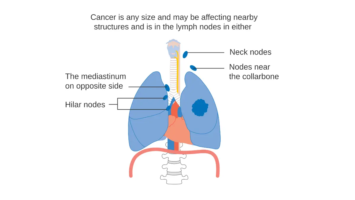 Lung Cancer Stages: Stage 1 to 4 Survival Truth 2026