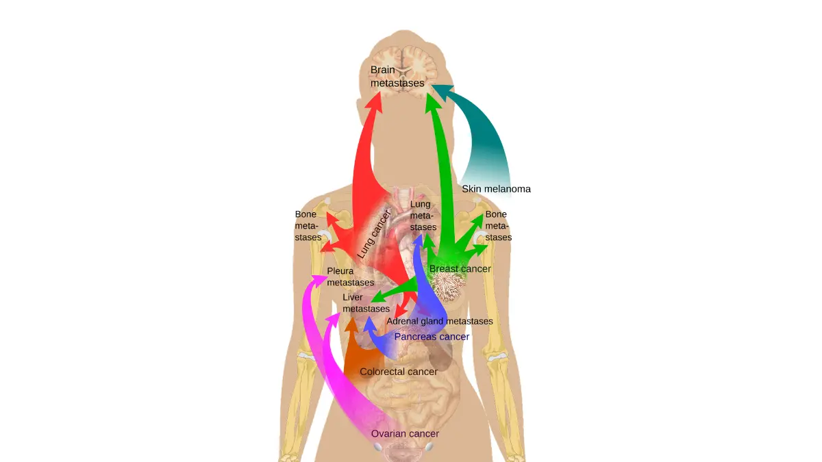 Melanoma Recurrence: 7 Warning Signs You Can't Ignore (2026)