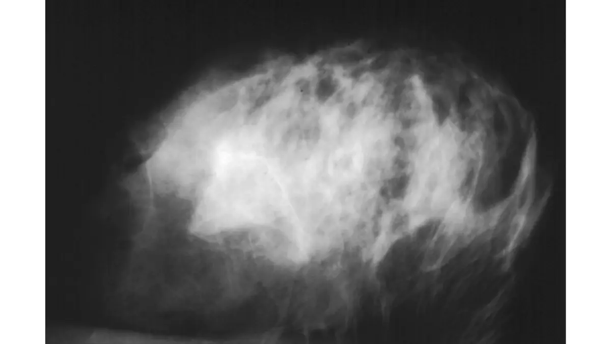 Breast Cancer Mammogram: Caught Early Means Age 40, Not 50