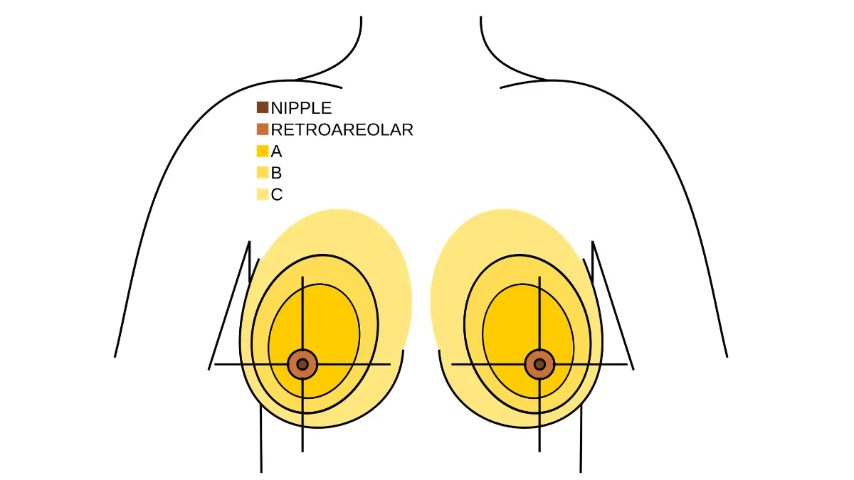 Breast Cancer Mammogram: Caught Early Means Age 40, Not 50