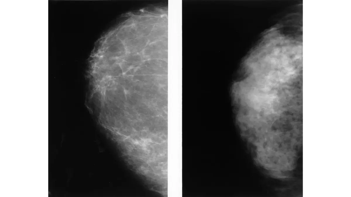 Breast Cancer Mammogram: Caught Early Means Age 40, Not 50