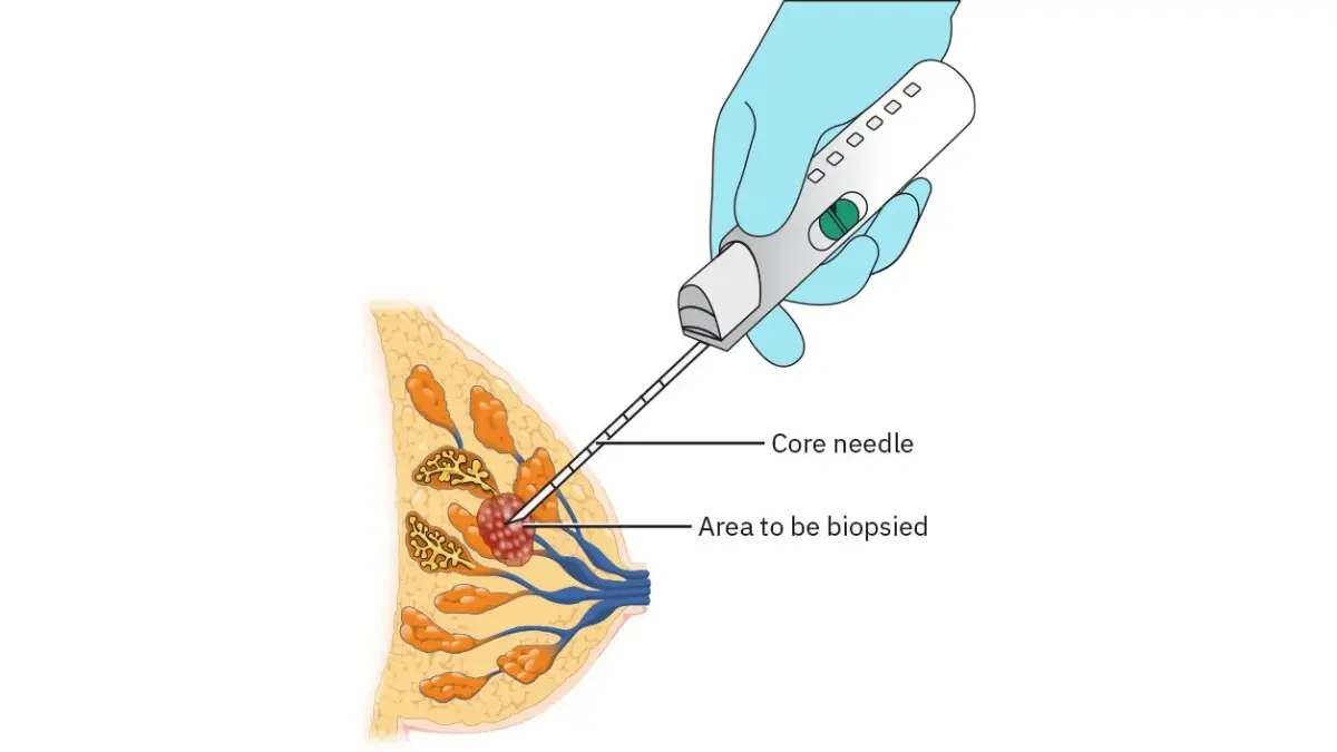 DCIS Breast Cancer: What 99% Survival Actually Means