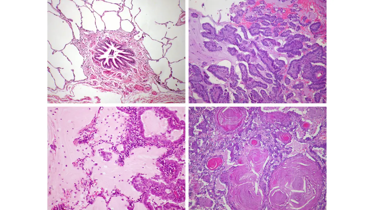 Lung Cancer Metastasis: 5 Sites, Signs and Key Treatments